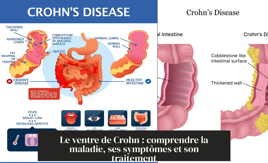 Le ventre de Crohn : comprendre la maladie, ses symptômes et son ...